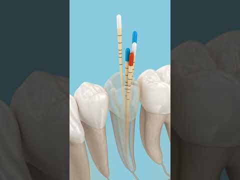 Dental root canal filling procedure. 3D Animation