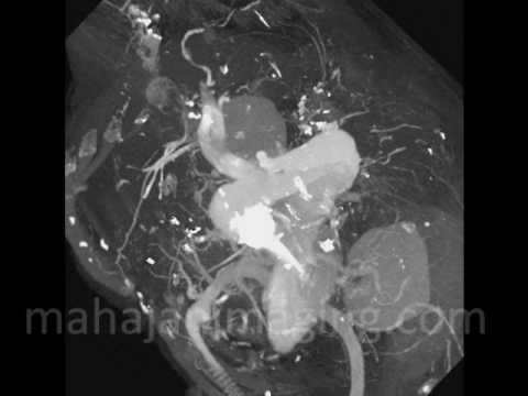CT Angiography Chest & Abdomen