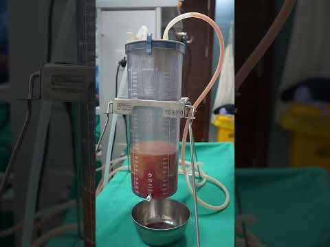 BBL Fat Transfer | BBL Surgery result | bbl #short #Short #shorts #share
