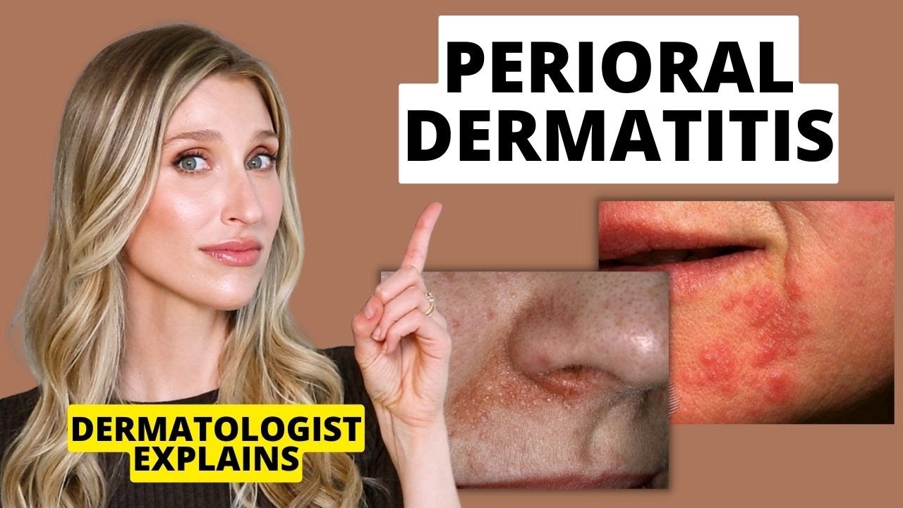 Dermatologist Explains Perioral Dermatitis (What it Looks Like, Causes, & Treatments) | Dr Sam Ellis