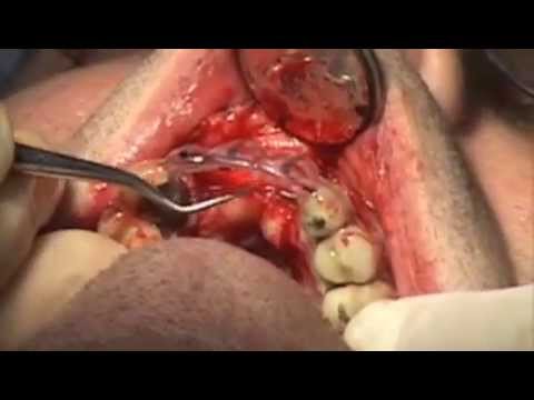 Dental implant Surgery by Dr. Edward Gottesman