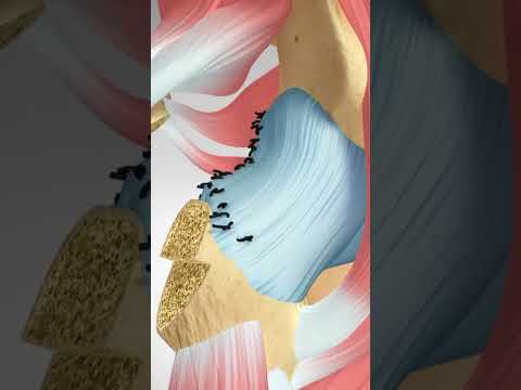 Open Surgery to Correct Hip Impingement (Irregularly Shaped Femoral Head) #hippain #hipinjury