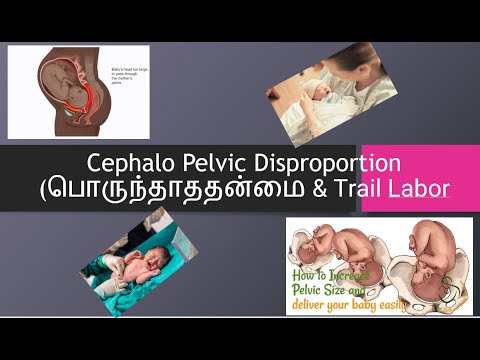 Cephalo pelvic disproportion CPD ( பொருந்தாததன்மை )