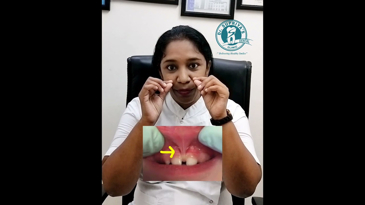 Gaps between my child's teeth. #babyteeth,#childhealth,#cavities,#decay,#oralhealth , #dentist