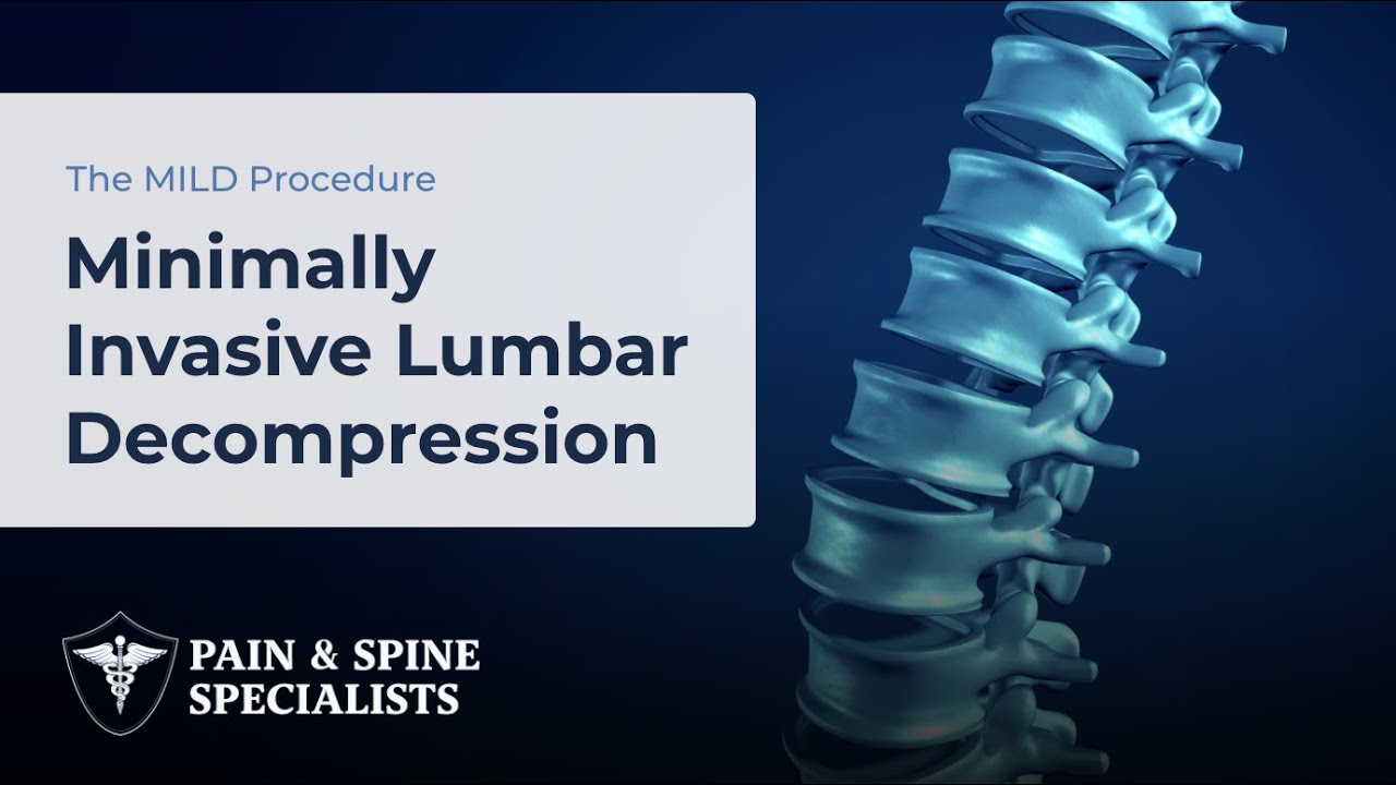 Minimally Invasive Lumbar Decompression | MILD Procedure