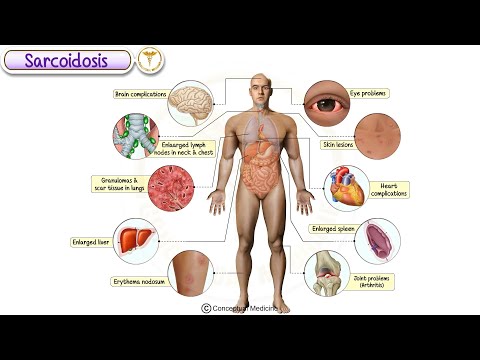 Sarcoidosis Animation High-Yield Internal Medicine for NEET PG/FMGE/USMLE