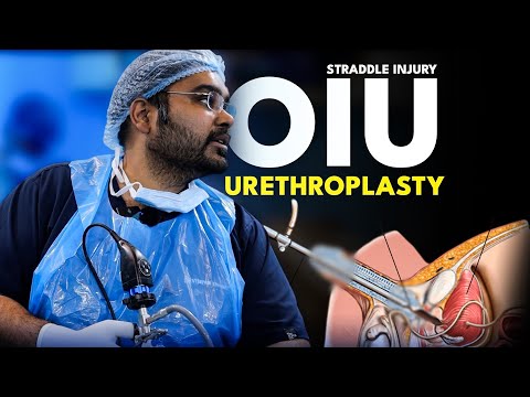 5 minute में Urethral Stricture का ईलाज