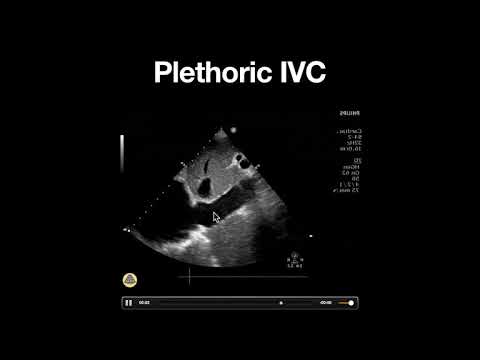 A Plethoric IVC