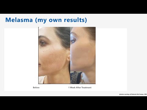 Webinar: Hyperpigmentation & Rejuvenation