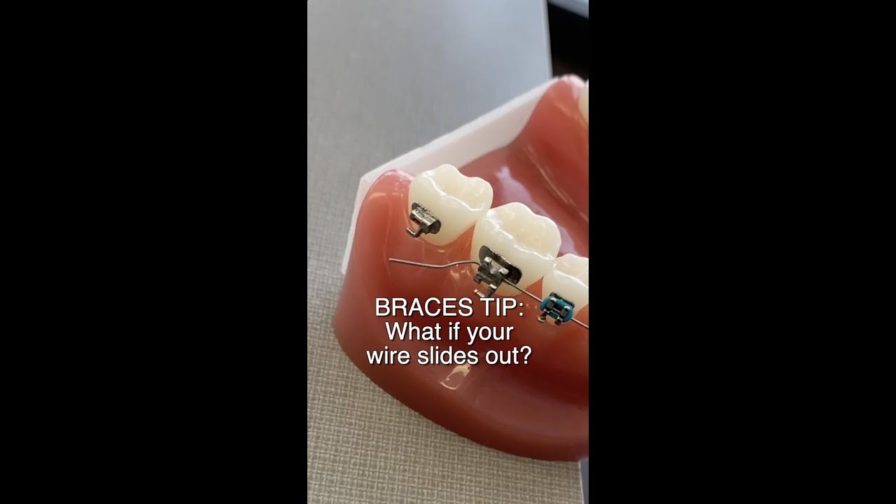 Braces Wire Poking Cheeks or Gums? Here's What to Do... 🦷 #shorts