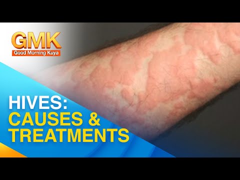 Cause and treatment for urticaria or hives | Usapang Pangkalusugan
