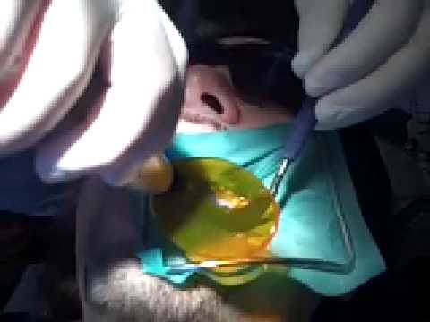 Dr. Miller fills a cavity