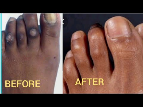 how l got rid of my corns and celluses on my toe and feet/ only 2 natural home made remedies used.