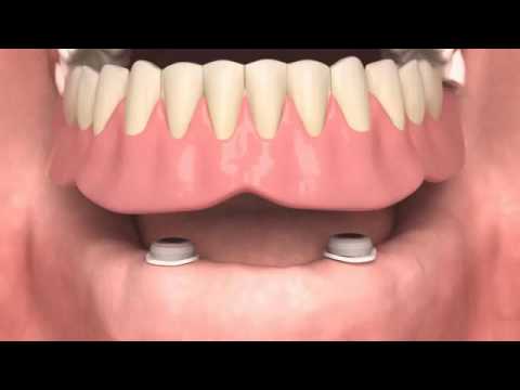 Locator™ - installation guide | Dentsply Sirona
