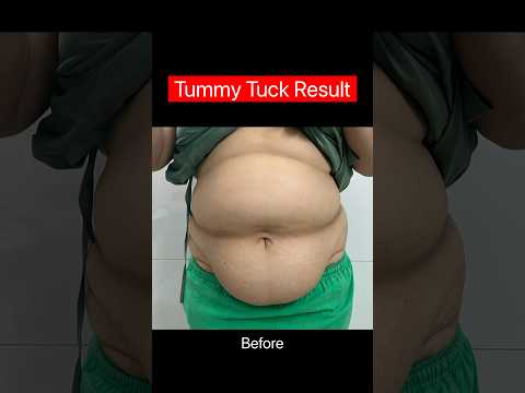 Belly Fat removal | Tummy tuck surgery result | Dr Iqbal Ahmed | Abdominoplasty