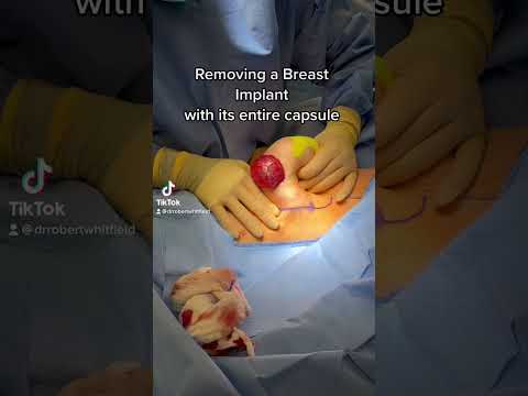 I Explanted My Silicone Breast Implants - Entire Capsule!