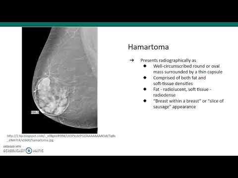 fibroadenoma vs hamartoma