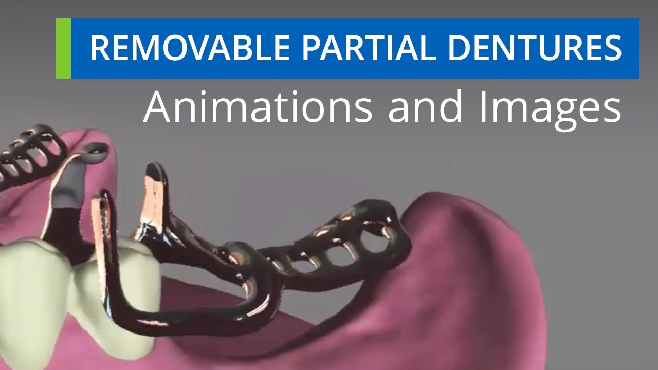 Removable Partial Dentures Animations & Images