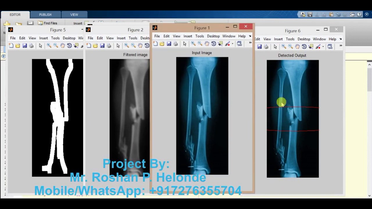 Bone Fracture Detection using image processing matlab project code
