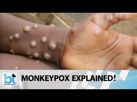 What Is Monkeypox Virus?