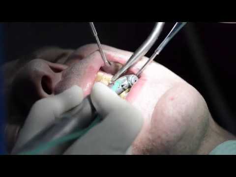 AWI Ceramic Dental Implants - Placement of premolar implant (25)