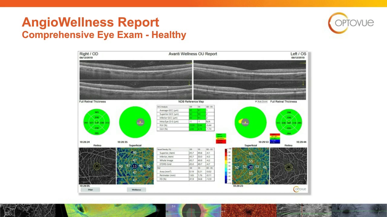 How to Get Started with OCT Angiography