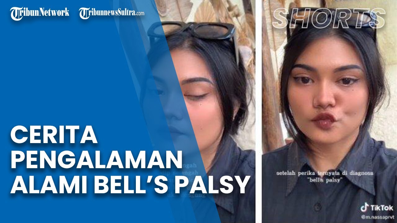 Viral Kisah Wanita yang Terkena Penyakit Bell's Palsy, Separuh Wajah ...
