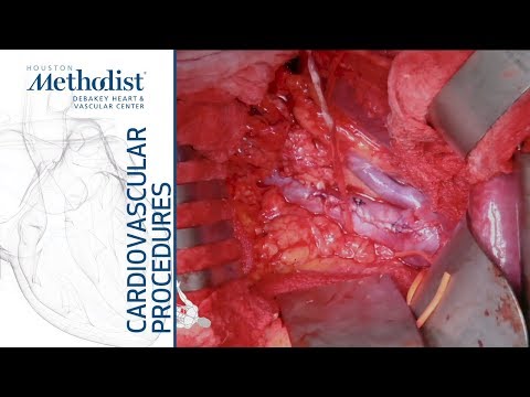 Open IVC Filter Removal (Maham Rahimi, MD, and Mujeeb Zubair, MD)