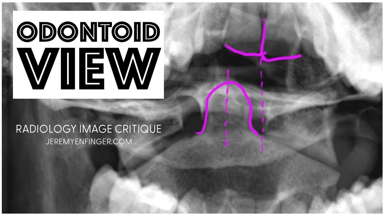 Radiology Image Critique: Odontoid View
