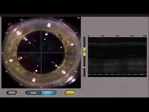 LenSx procedure on right eye of patient DC