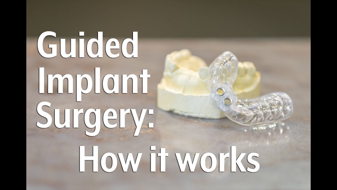Guided implant surgery - how it works