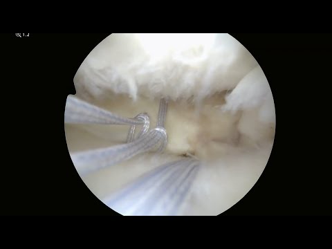 Medial Meniscus Posterior Root Repair