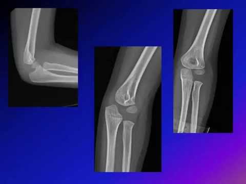 Monteggia Fracture - Pediatric - Pediatrics - Orthobullets