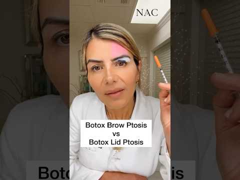 Botox Brow Ptosis vs. Botox Lid Ptosis #botox #beauty