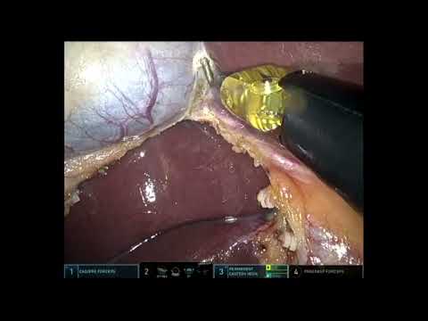 Robot Cholecystectomy