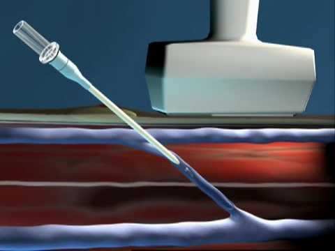 VNUS ClosureRFS Device at Capital Health Vein Center | Capital Health Hospital