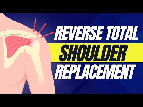 What Is Reverse Total Shoulder Replacement