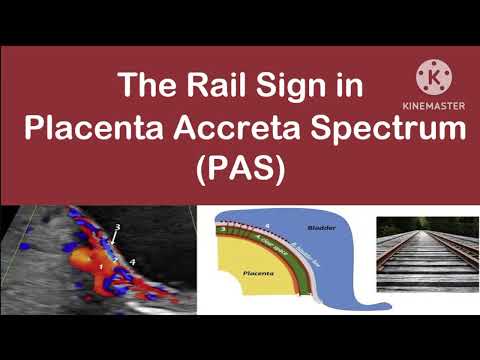 The rail sign of placenta accreta on ultrasound