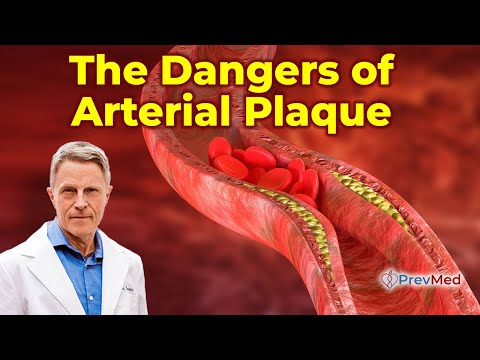 The Truth About Soft Plaque: Everything You Need To Know