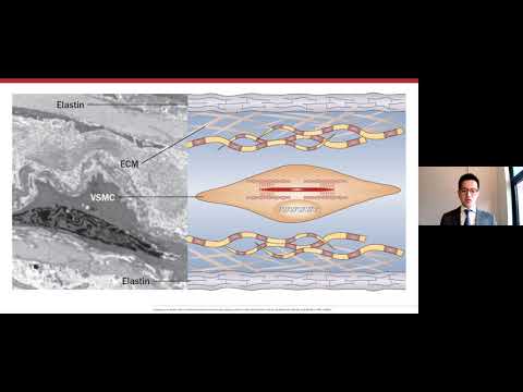 Natural History of Thoracic Aortic Aneurysm
