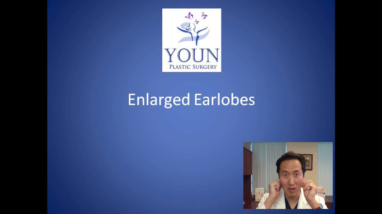 How Can I Make My Earlobes Smaller - Earlobe Reduction Consultation - Dr. Anthony Youn