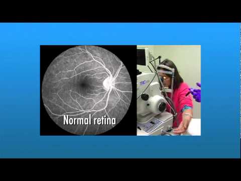 Fluorescein Angiography for AMD