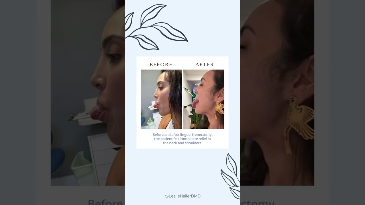 Before and after lingual frenectomy #Shorts