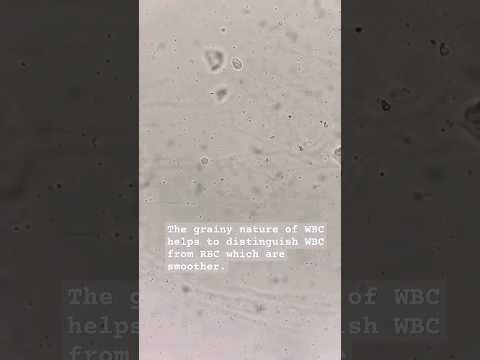 Urinalysis WBC White Blood Cells vs RBC Red Blood Cells