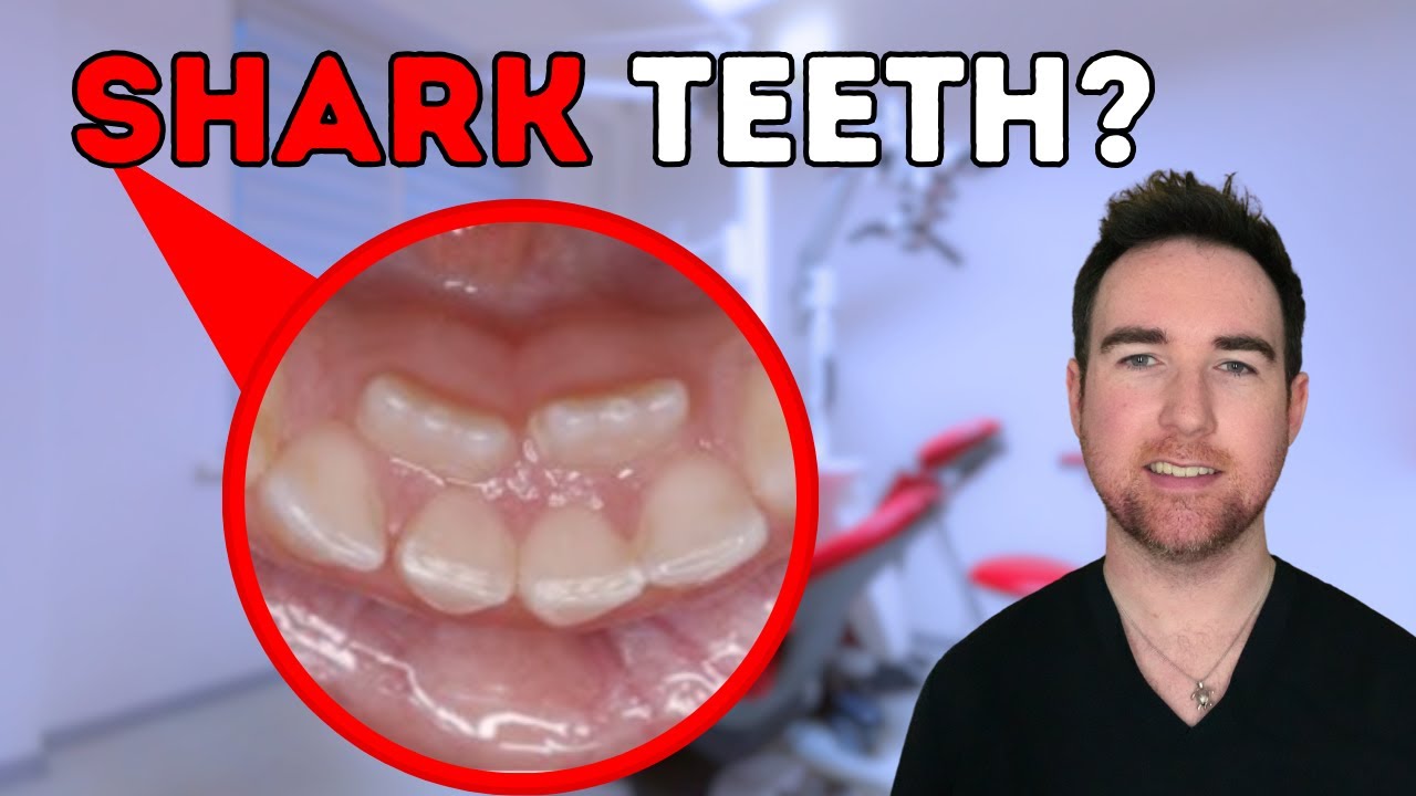 Baby teeth won't fall out? (Dentist Explains)