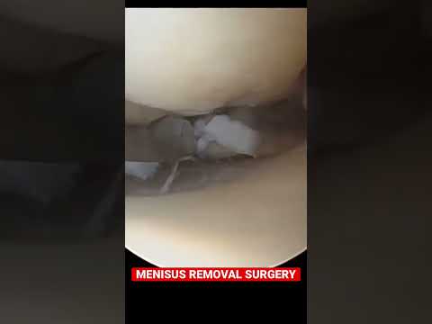 👀 Meniscus Removal Surgery #shorts