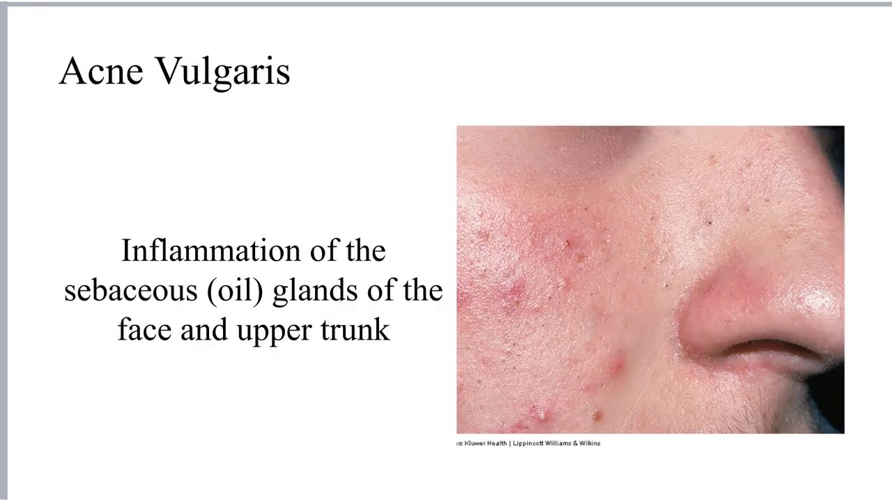 Acne Pathophysiology & Drug Action
