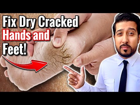 How to Fix DRY and CRACKED Hands and Feet | 5 Best Creams for Dryness