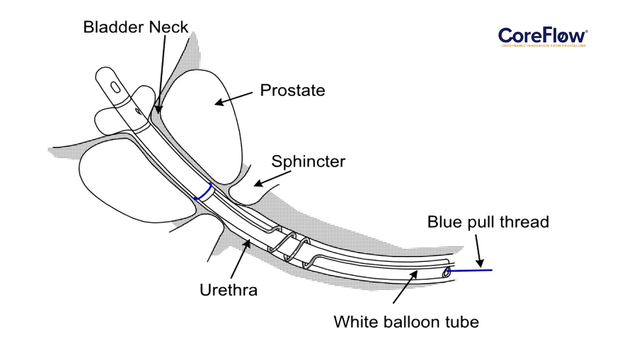 CoreFlow® – Soft Stent (ENG subtitle)
