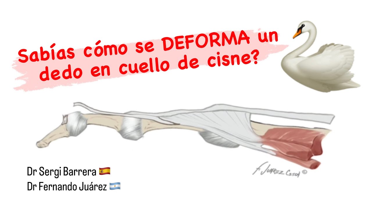 🦢 Sabes cómo se desarrolla una DEFORMIDAD de los DEDOS en cuello de CISNE❓